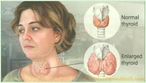 Nota: Tipos de Bocio – Medicina Cardiometabólica