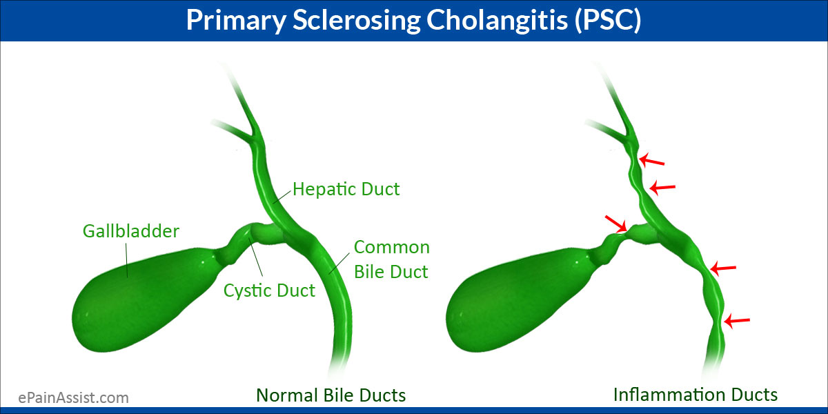 Resumen: Colangitis esclerosante primaria – Medicina Cardiometabólica
