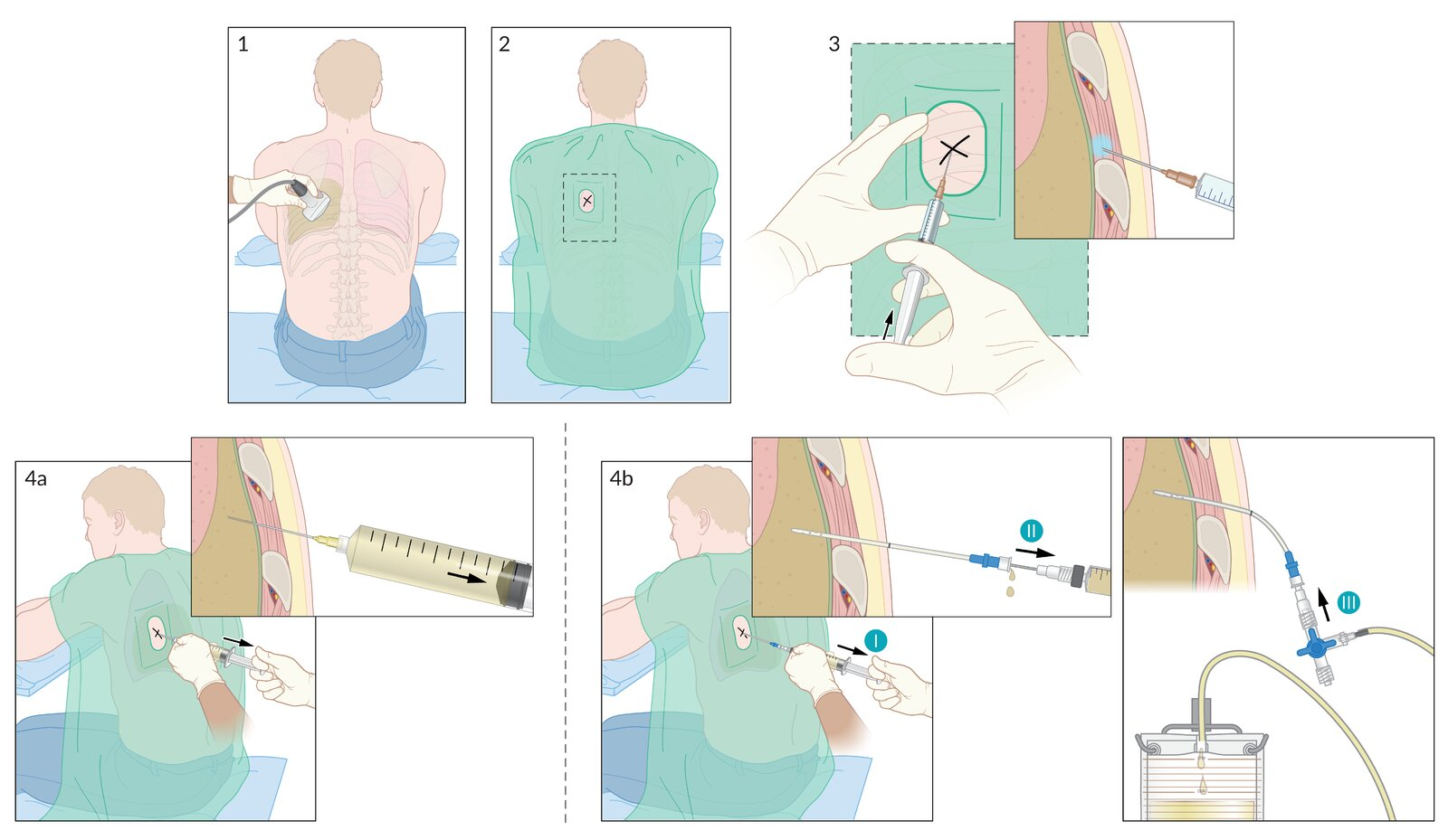 Toracocentesis – Medicina Cardiometabólica