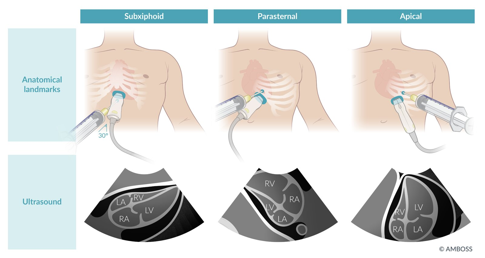 Pericardiocentesis – Medicina Cardiometabólica