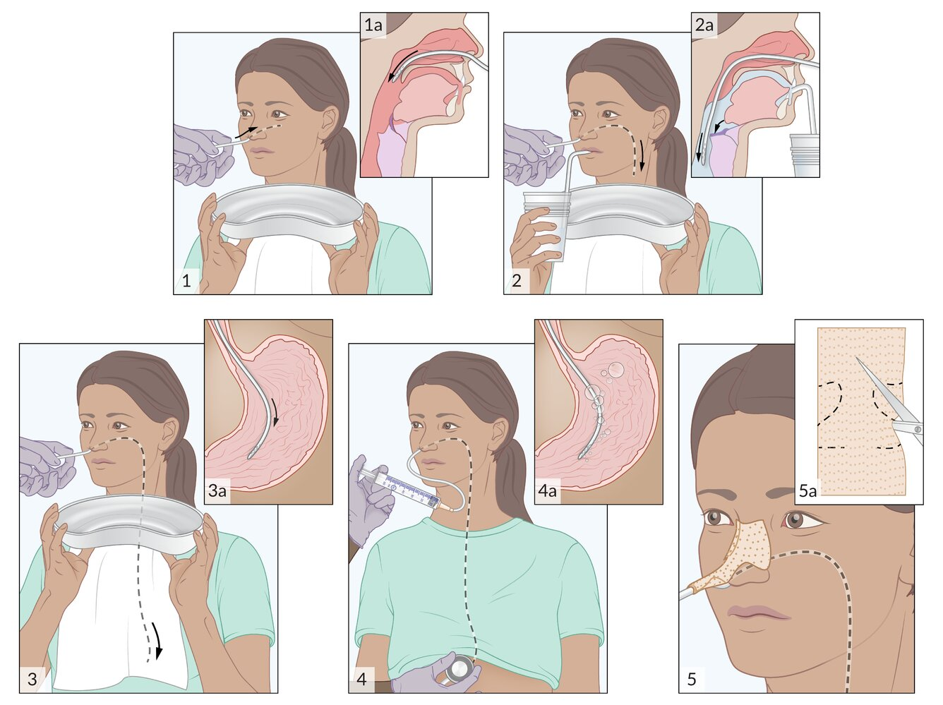 Colocación de sonda nasogástrica – Medicina Cardiometabólica
