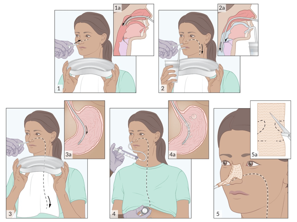 Colocación de sonda nasogástrica – Medicina Cardiometabólica